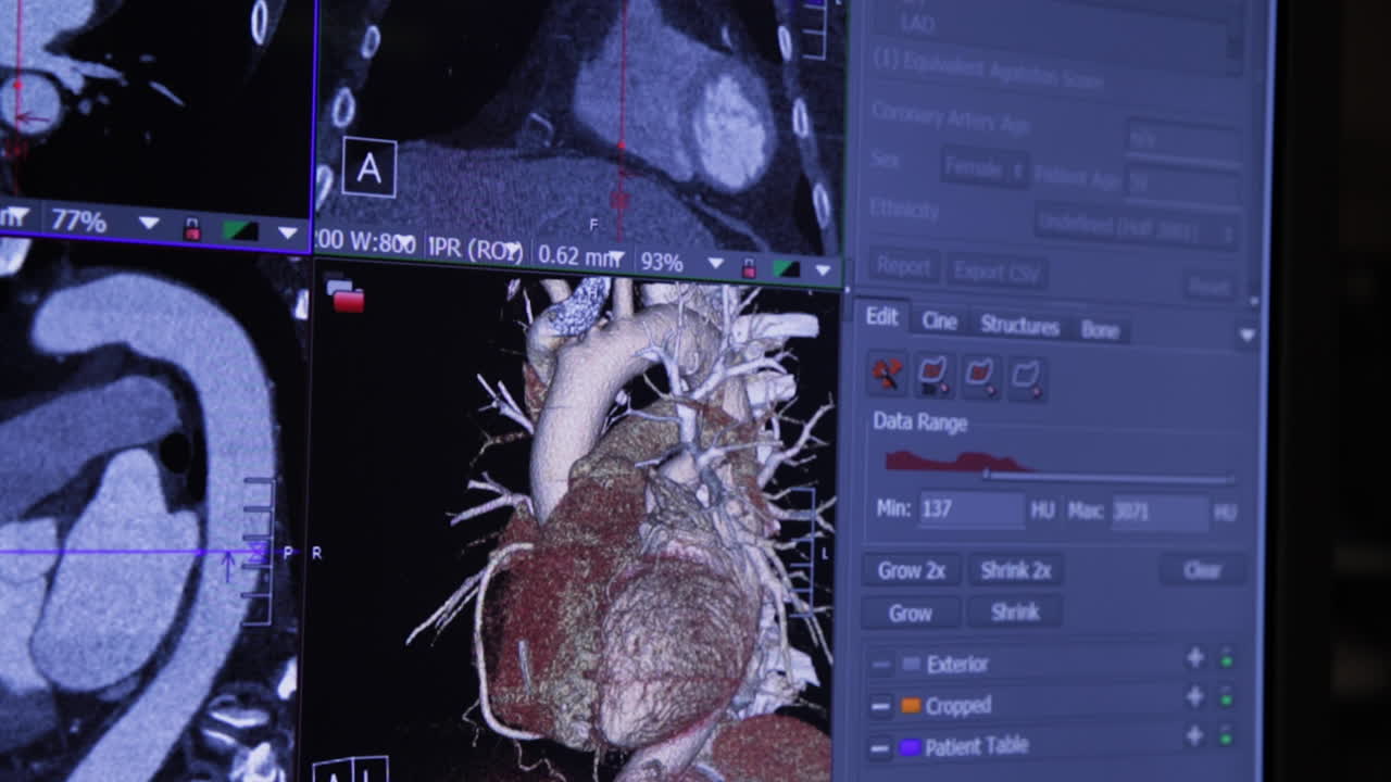 Premium stock video - Heart scan results, camera tilts down across ...