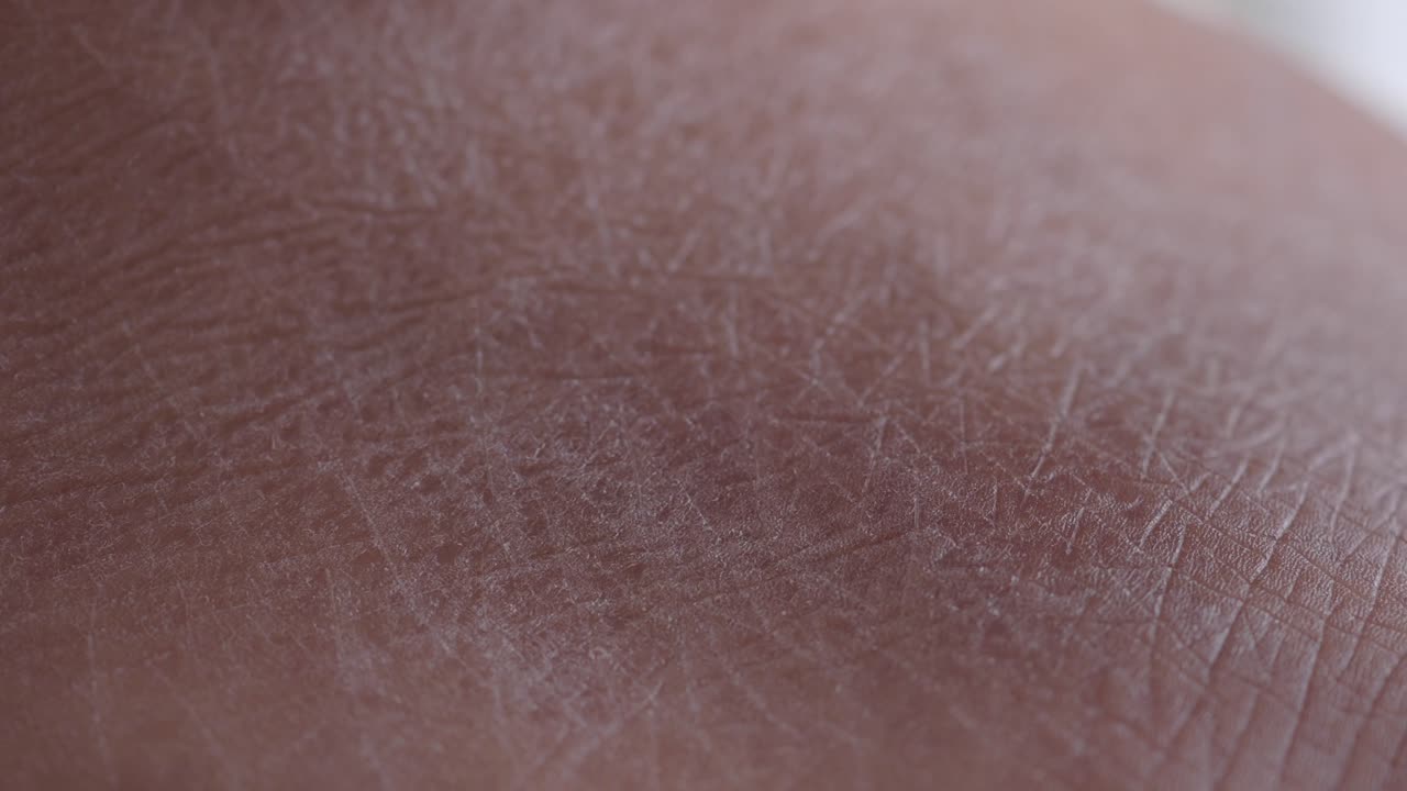 Premium stock video - Close-up of dry skin on hand