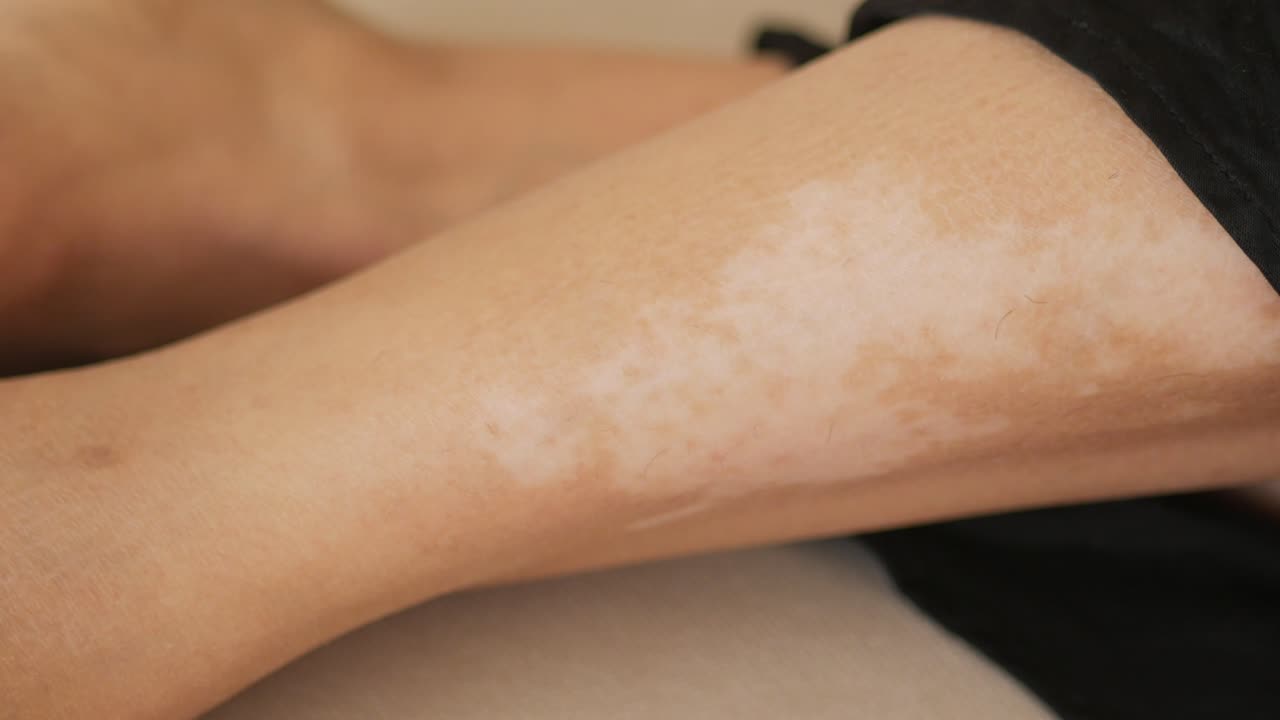 Skin Discoloration on Leg | freepik