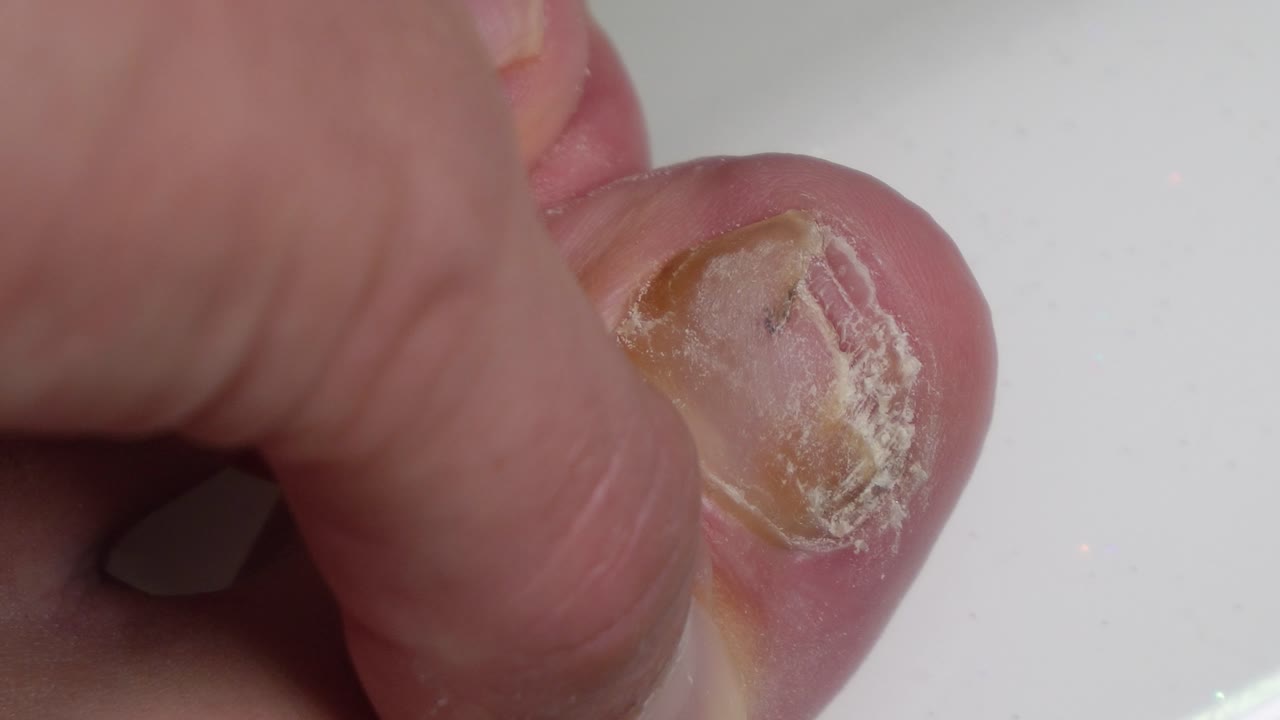 A Cracked And Discolored Toenail Caused By Mycosis - Fingers Rub The ...