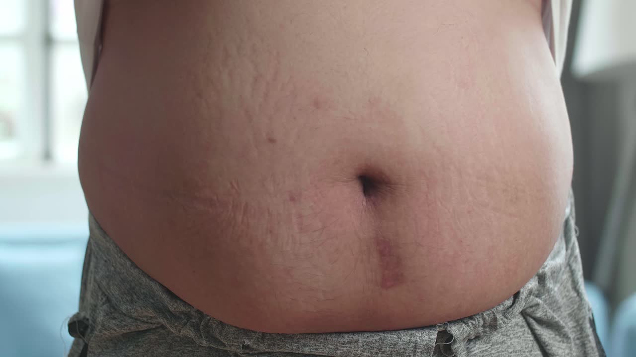 Close Up Of Fat Man Shows His Belly Fat | Premium Stock Video Footage
