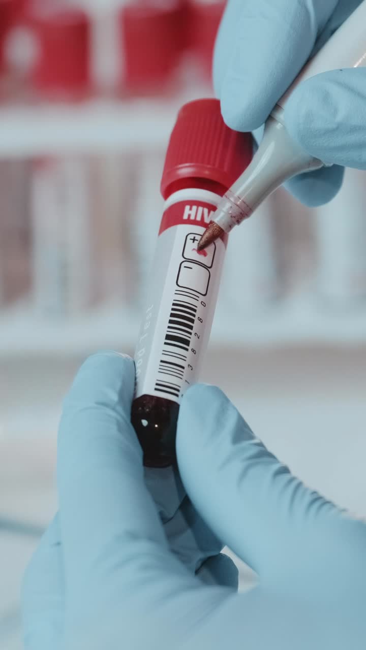 Healthcare professional handles hiv blood test tube in a clinical lab ...